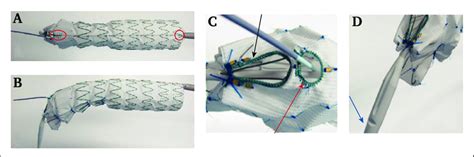Fenestrated Thoracic Endovascular Aortic Repair F Tevar Stent Graft