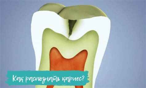 Как распознать кариес Стоматология Прага