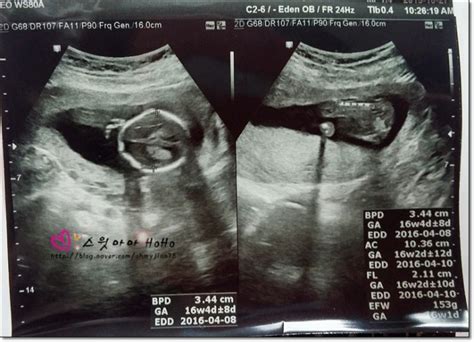 태아 초음파사진 보는법 초음파사진 용어 네이버 블로그