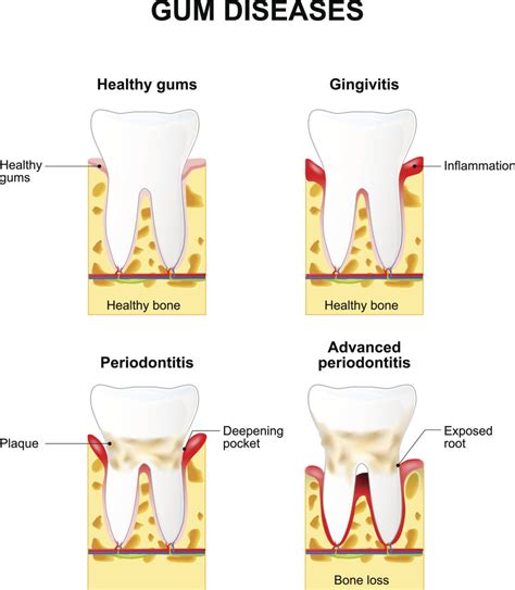 Gum Disease Faqs Plano Tx Periodontal Treatment Dallas