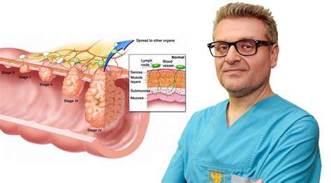 ИНТЕРВЈУ СО ДОЦ Д Р АНДРЕЈ НИКОЛОВСКИ Појава на крв во столицата запек течни столици болки