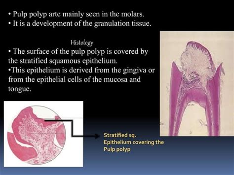 Pulp Polyp And Gingival Polyp PPTX