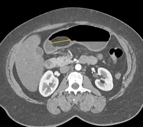 Gastric Lipoma Stomach Case Studies Ctisus Ct Scanning
