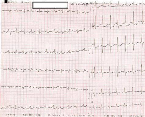 Atrial Flutter The Flutter Rate Is 500 Beats Min With 2 1 Conduction Download Scientific