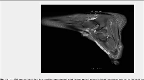 Figure 3 From Unusual Location Of Rheumatoid Nodule Case Report Semantic Scholar