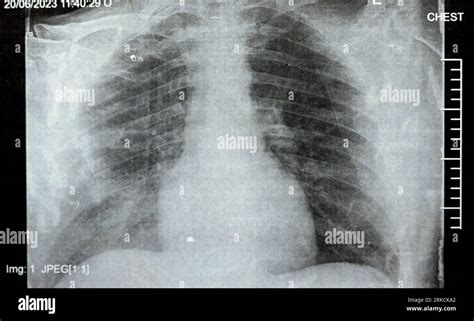 Plain X Ray Chest Showing Infectious Pulmonary Process Pneumonia With Right Side Minimal Para