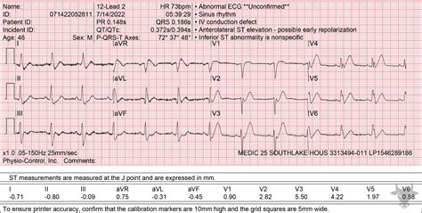Hyperacute T Waves Ecg Stampede