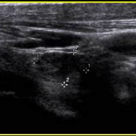 Hypercellular Parathyroid Gland Consistent With Adenoma Nests Of Download Scientific Diagram