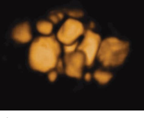 Figure 1 From Sonographic Detection Of The Ovarian Hyperreactio Luteinalis In Pregnancy