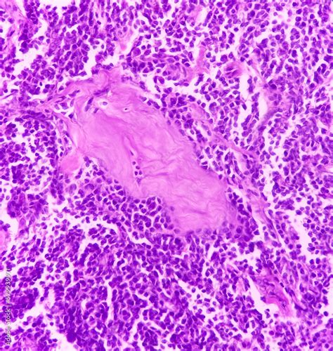Supraclavicular Lymph Node Biopsy Microscopic Image Showing Benign Follicular Hyperplasia