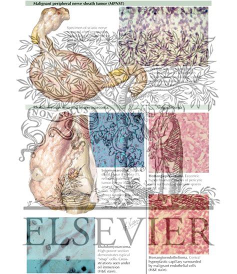 Neurosarcoma Myosarcoma Angiosarcoma