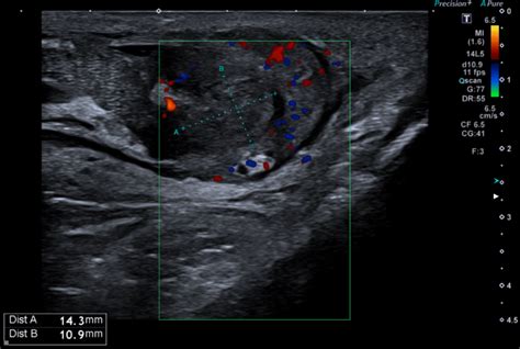 Epididymitis Ultrasound