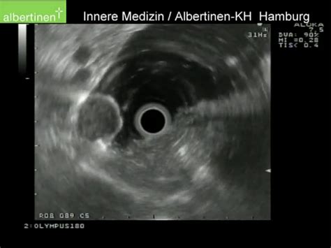 Endoscopic Ultrasound Of The Stomach Gist Doccheck