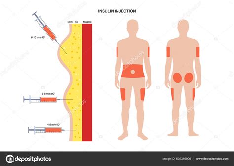 Insulin Injection Sites Stock Vector By ©pikovit 539346906