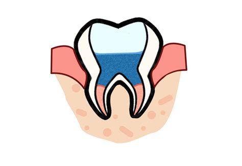 Treatment Option Pulpotomy Severe Pulpitis