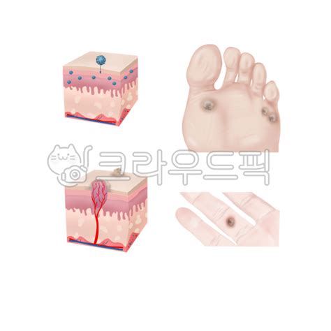 해부학 메디컬일러스트 Anatomy 피부 질환 사진이미지일러스트캘리그라피 Nchuccida작가
