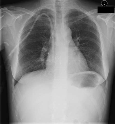 Clamshell Lung Transplant At Nick Colon Blog