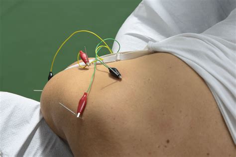 Neuromodulación San Juanen Fisioterapia