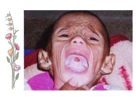 Congenital Syphilis