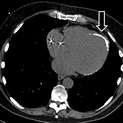 Computed Tomography Scan Showing Calcifications Download Scientific Diagram