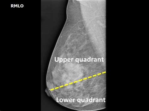 Abnormal Mammogram Looks Like What Mammogram Information Mount Sinai