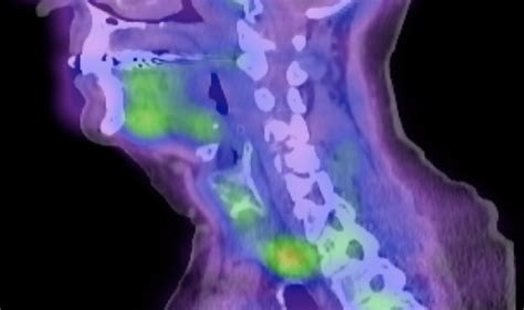 Primary Hyperparathyroid