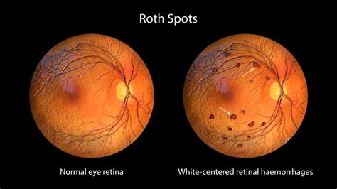 Roth Spots Detection Symptoms And Treatment