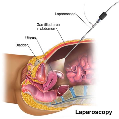 Infected Laparoscopic Incision