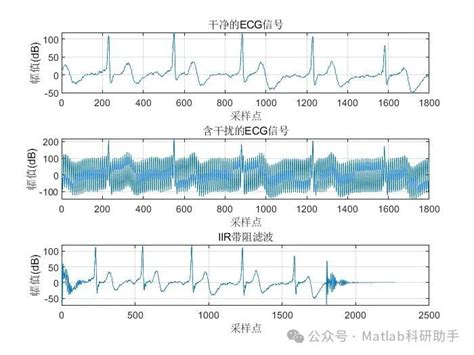【心电信号】基于iir和fir滤波器实现心电图信号去噪附matlab代码 卡尔曼滤波过滤心电图 csdn博客