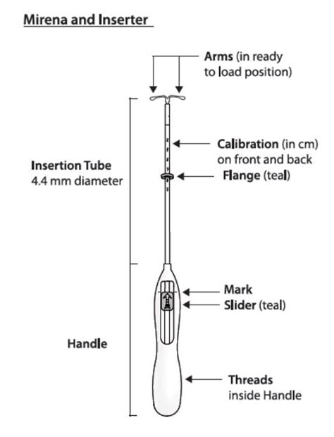 Iud Insertion Steps