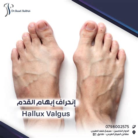 انحراف إبهام القدم هو حالة يمكن الدكتور باسل البلبيسي
