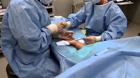 Types Of Anesthesia For Carpal Tunnel Surgery At Jenenge Blog