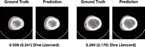 Figure 3 From Segmentation Of Intracranial Hemorrhage Using Semi