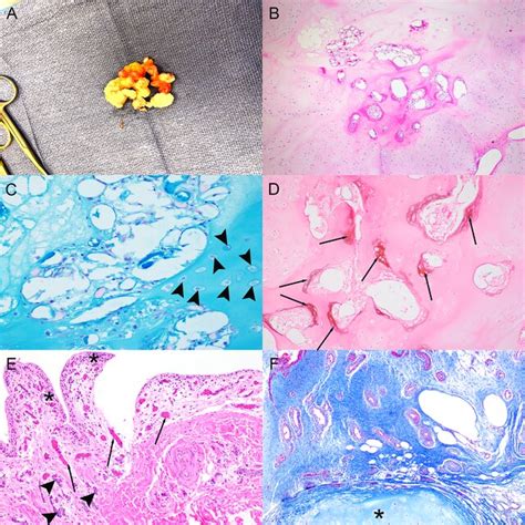Semimembranosus Tendon And Bursa Visualized With A 12 Mhz Download Scientific Diagram Semimembranosus Tendon And Bursa Visualized With A 12 Mhz Download Scientific Diagram