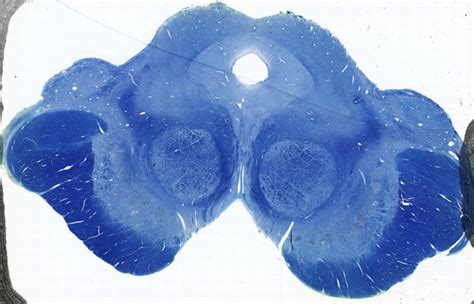 Rostral Midbrain Superior Colliculus Level Diagram Quizlet