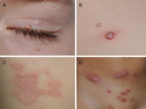 Molluscum Contagiosum Pictures Molluscum Contagiosum Pictures