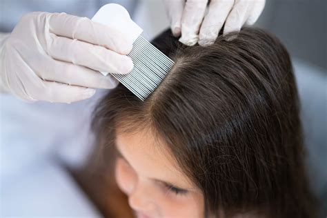 How To Get Rid Of Head Lice Head Lice Removal