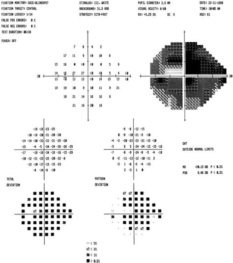 Sparing Of Upper Temporal Quadrant Of The Fovea Download Scientific