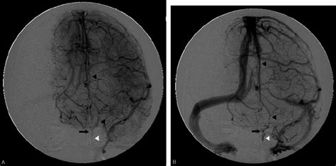 Case 2 Dsa Left Ica Injection Early And Intermediary Venous Phase
