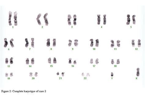 Translocation T 16 21 P11 Q22 And Acute Myeloid Leukaemia