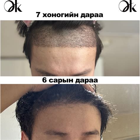 Чондам Зүсэлтгүй аргаар 4000 ширхэг үс 6 сарын дараа монгол үйлчлүүлэгч Бодит зураг Бодит үр