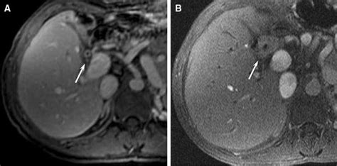 Periductal Infiltrating Cholangiocarcinoma In A 31 Year Old Man With