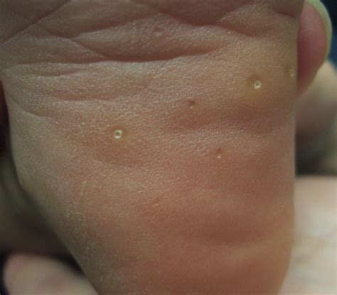 Punctate Keratosis