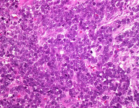 Ewing Sarcoma Of Bone Light Micrograph Stock Image C061 1655