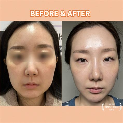 얼굴지방흡입 이중턱 지방흡입 후기 2년 뒤 부작용 흉터 관리 붓기 가격 바본 유지기간 네이버 블로그