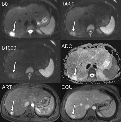What Is A Mri Liver With Contrast At Helen Ball Blog