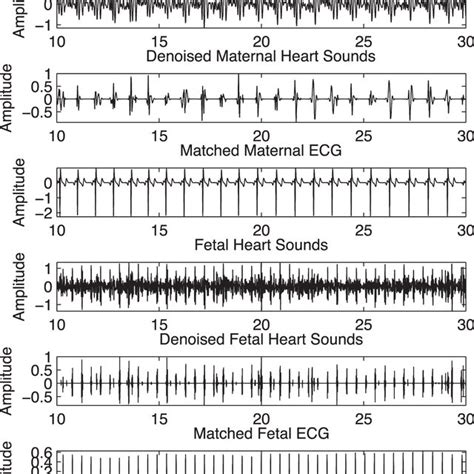 A 20 Second Example Of Extracted Fetal Heart Sound Signal Denoised Download Scientific