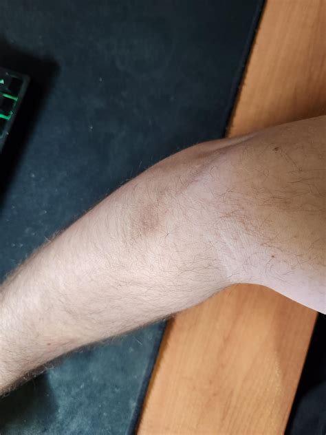 Bruising At Injection Site Near Forearm R Bpc 157