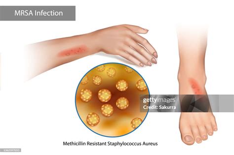 Mrsa Superbug Infection Methicillin Resistant Staphylococcus Aureus