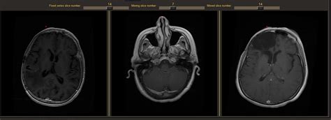 Simpleitk Registration Working But Applying The Transform To A Single Point Does Not Beginner